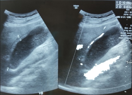 Enfermedades de la vesícula biliar – CIRUGÍA Y ENDOSCOPIA